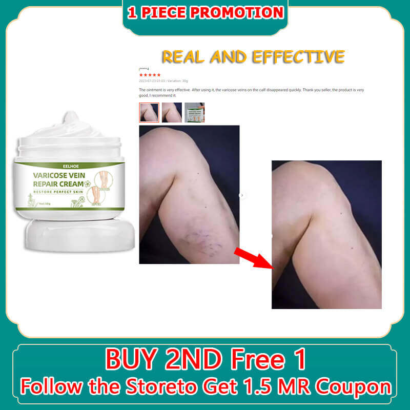 minyak urat ubat urat timbul jamu sakit urat varicose veins treatment ...