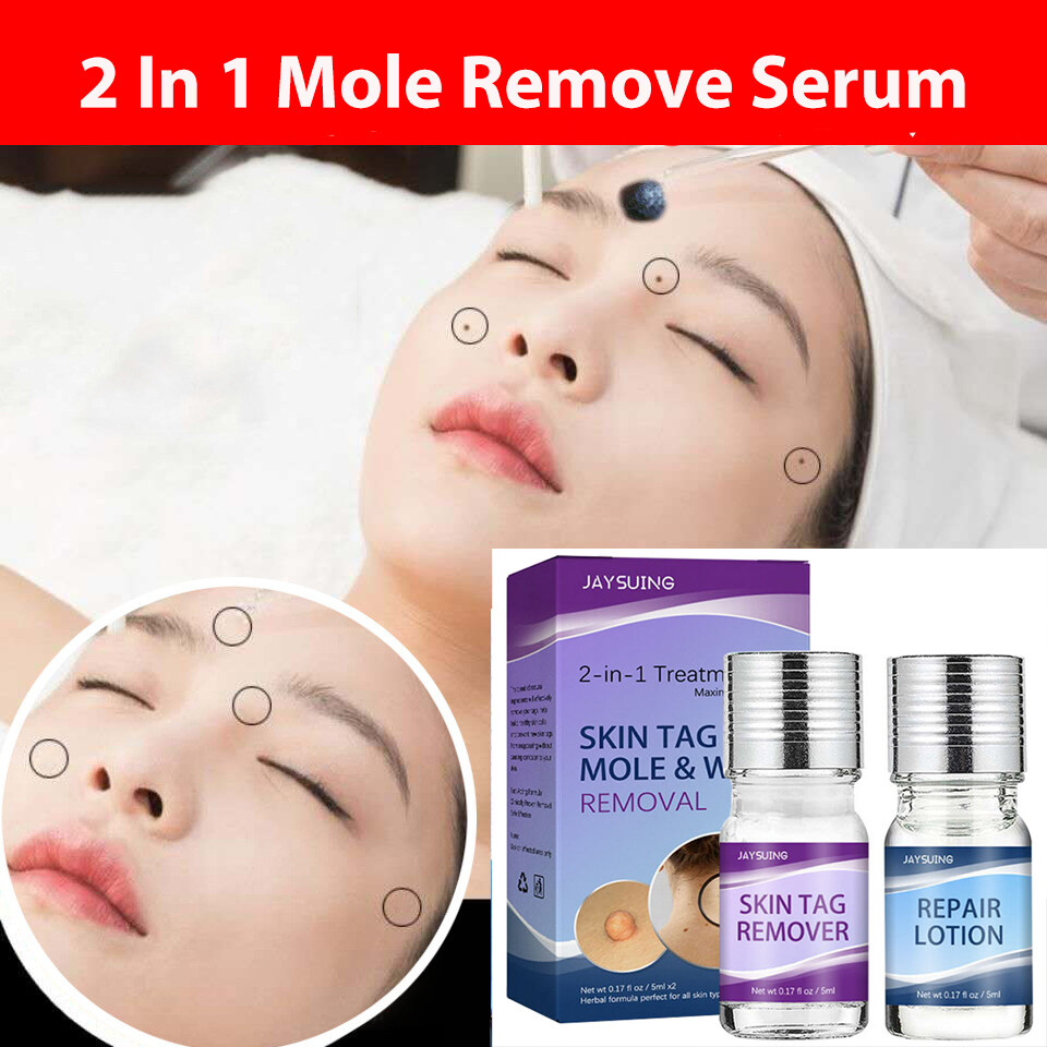 Mole Remove Serum Wart Removal Fade Melanin Spots Repair Skin Tag Foot ...
