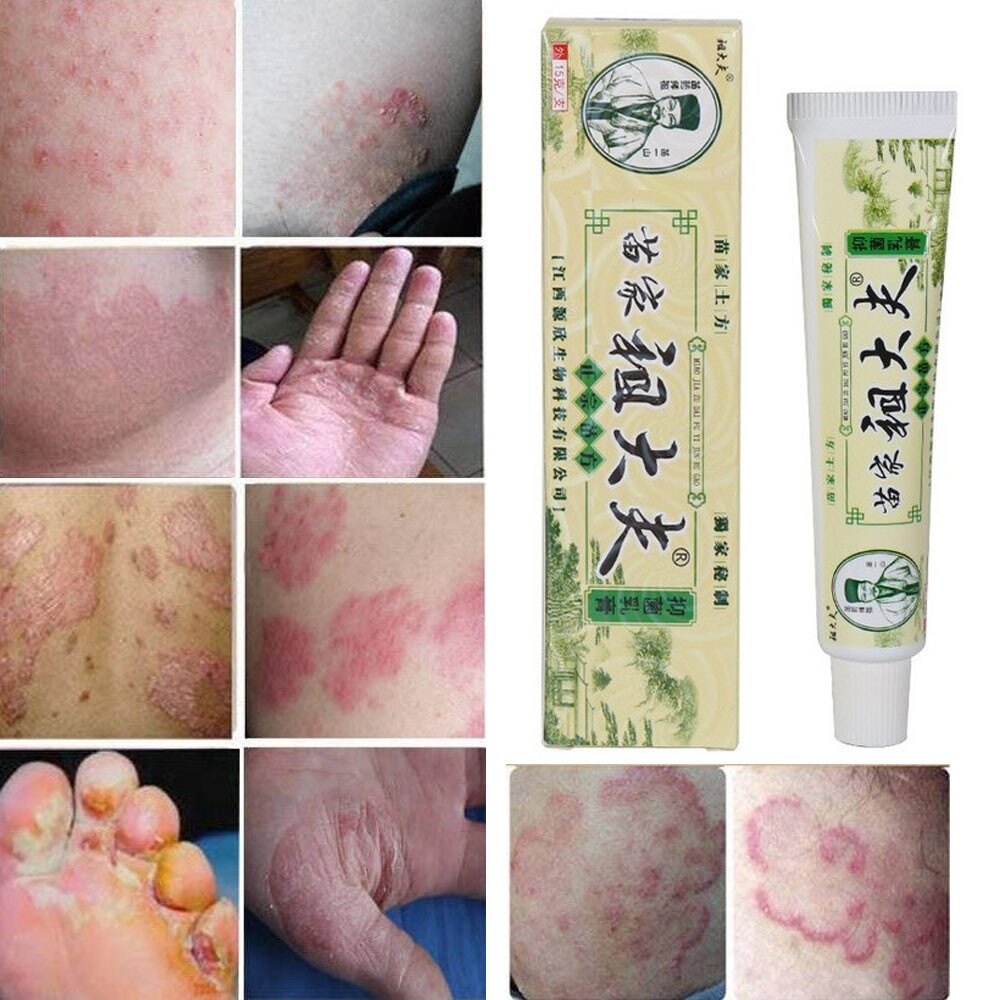 Sports Safety-Hypersensitivity Topical External Skin Itching Herba ...