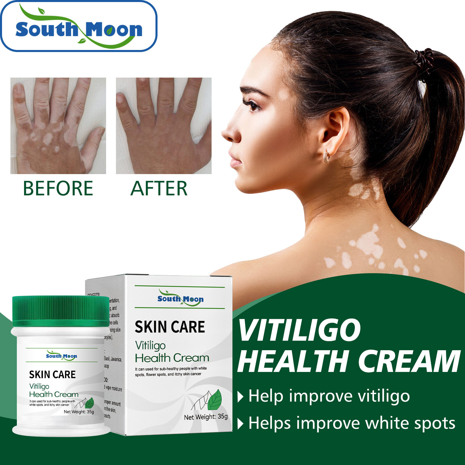 South Moon Vitiligo Repair Cream White Spot Care Cream Vitiligo ...