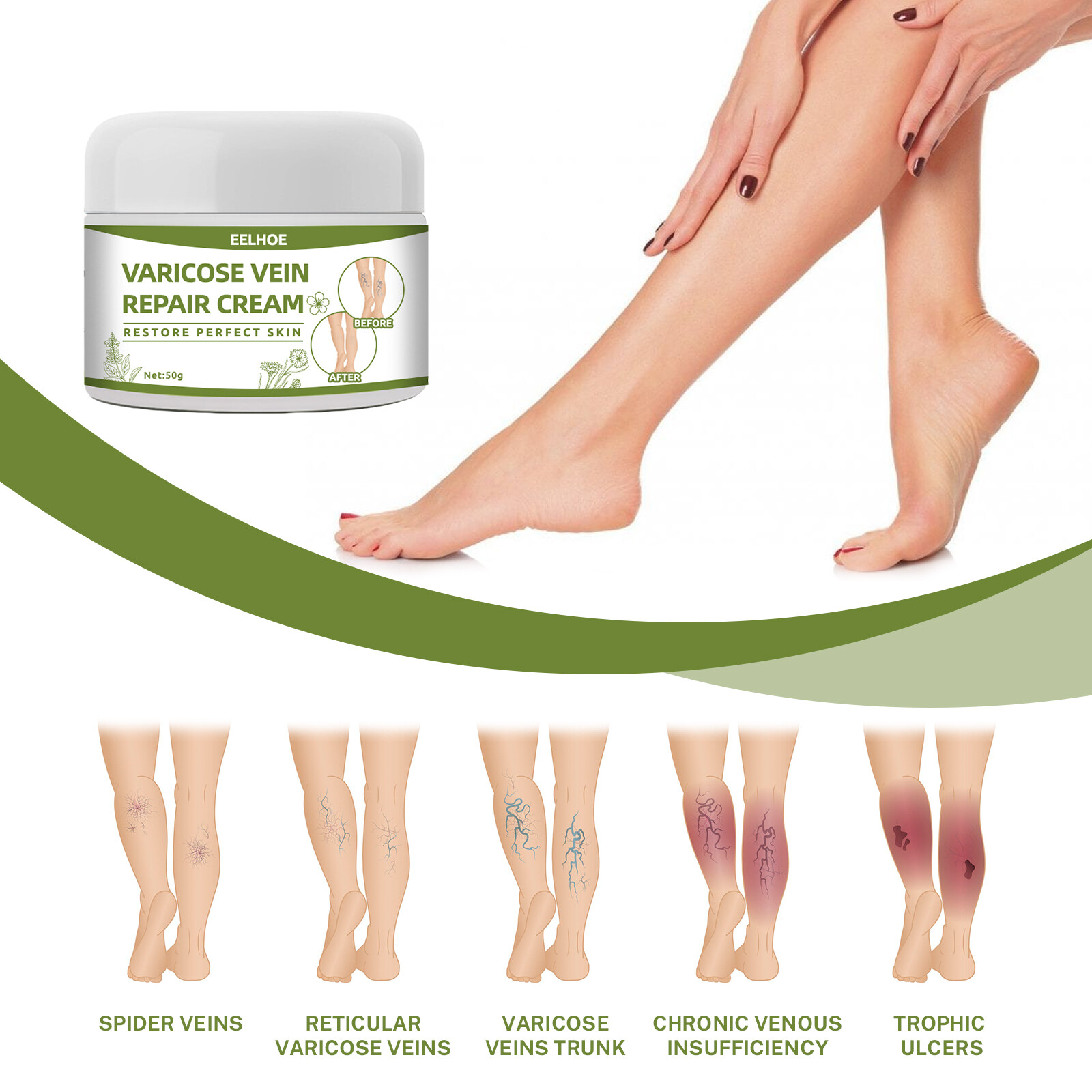 Eelhoe Varicose Vein Repair Cream Effective Convenient Plant Extracts ...