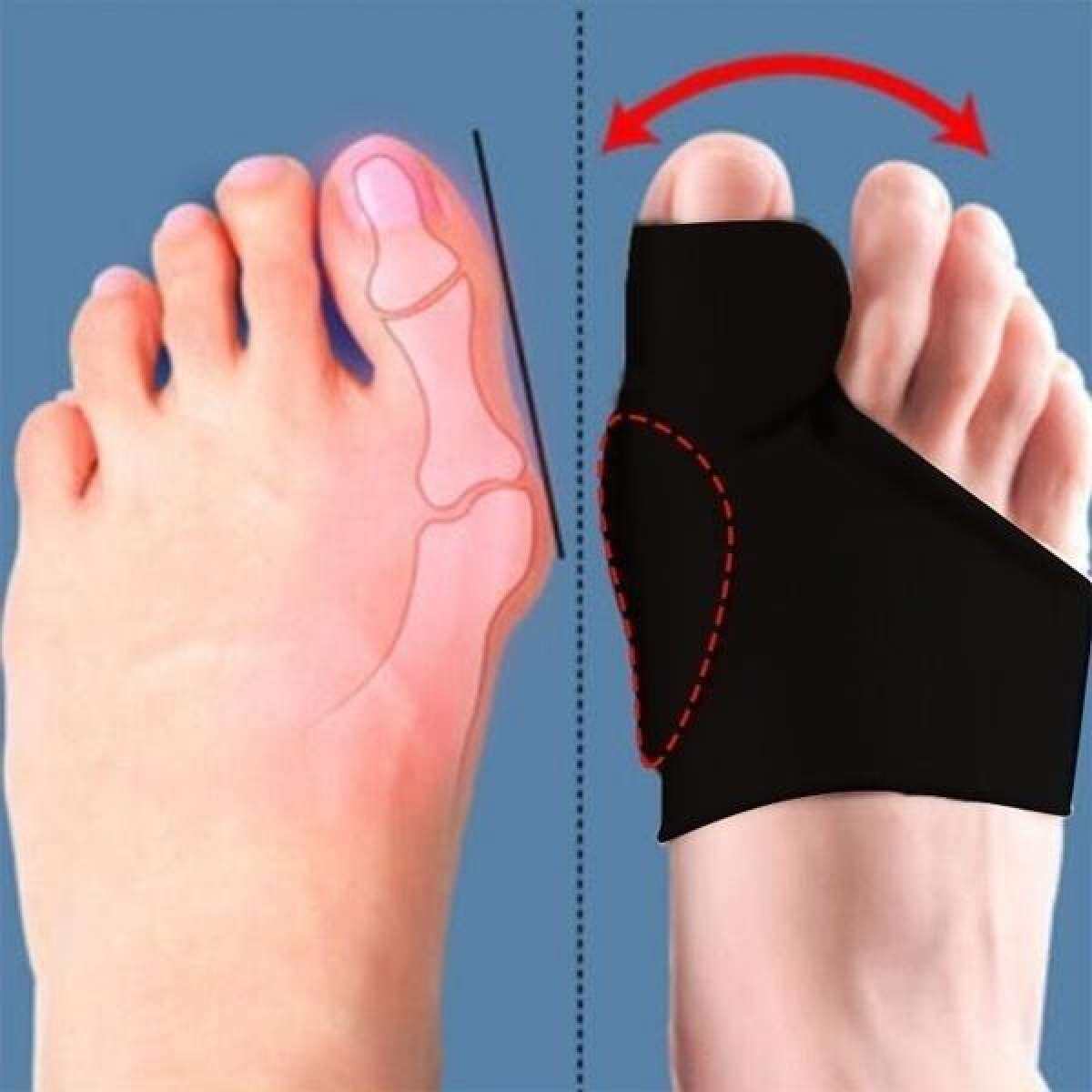 Big Toe Hallux ตัวแยกนิ้วเท้าที่ชิดกันที่รองปุ่มหัวแม่เท้าฟุต Bone ...
