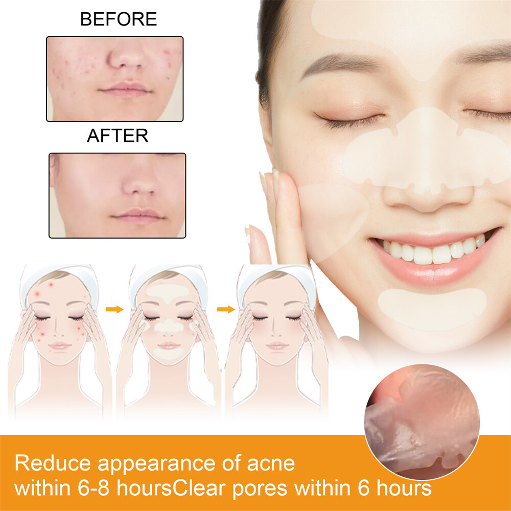 UBetter Acne Pimple Patch Acne Treatment Stickers Pimple Remover Tool ...