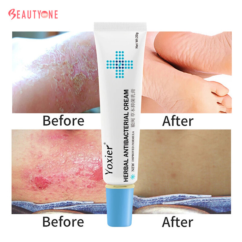Anti fungal ointment Yoxier Herbal Antibacterial Cream 20g ...