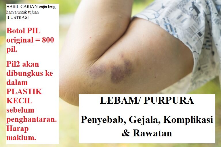 tanda Lebam (KRONIK/LAMA) 淤青 紫癜(慢性/旧伤) Purpura/ Blood spots #bentuk PIL ...