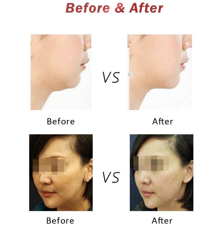 Mini HIFU RF Radar สาย V - Shape Anti - wrinkle กระชับผิว Ultrasound ...