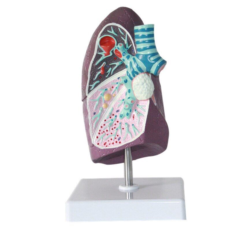 Medical Human Pathological Pulmonary Model Medical Model Pulmonary ...