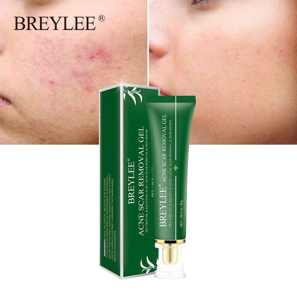 BREYLEE Acne Pimple Scar Removal Stretch Marks Pigmentation Treatment ...