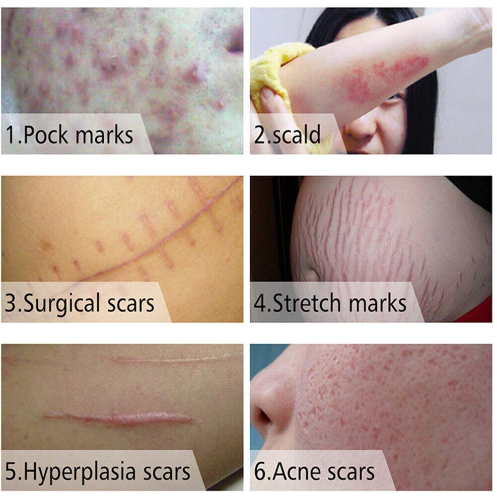 Care Skin Body Smooth Serum Treatment Scars Surgical Burn Marks Stretch ...