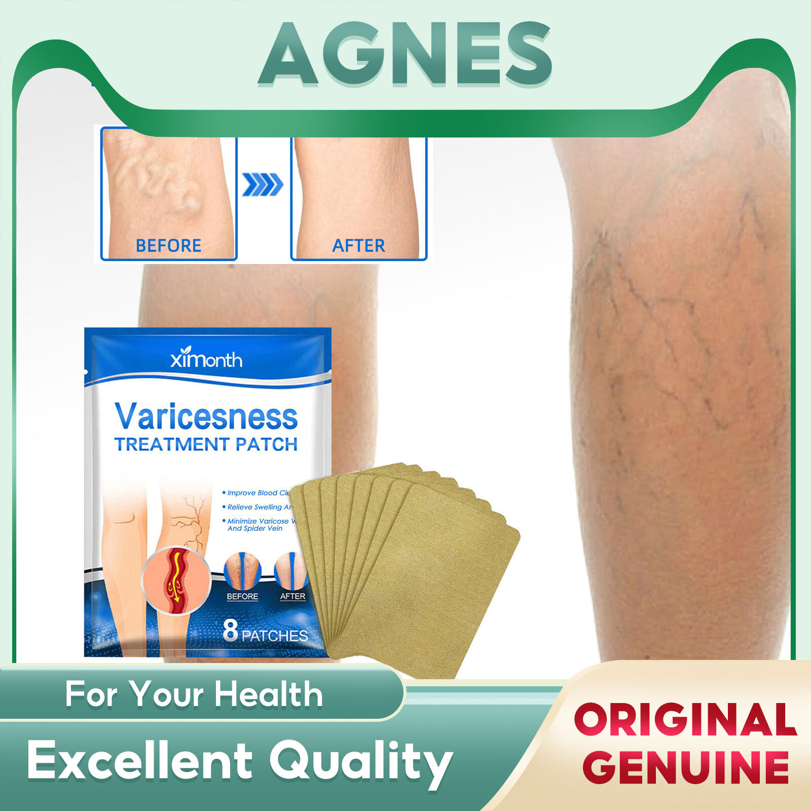 Ximonth Varicose Veins Vasculitis Patch Vascular Veins Remover Spider ...