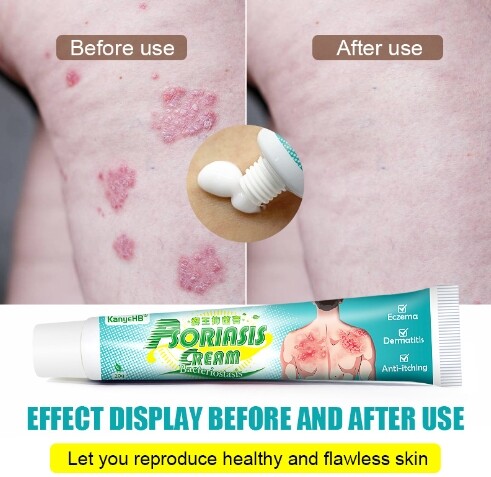 Ringworm cream for skin external cream Moss cream 20g | Lazada