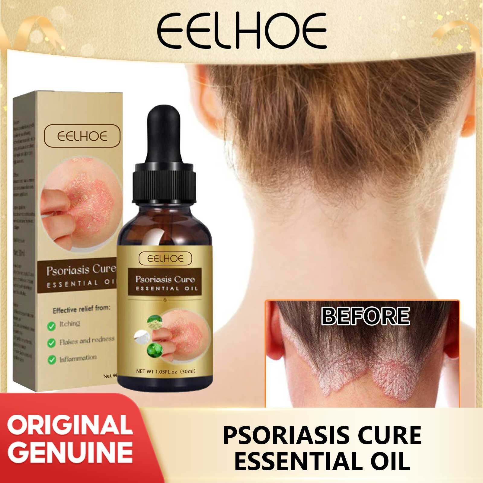 Eelhoe Psoriasis Antibacterial Serum Anti Itching Dermatitis Eczema ...