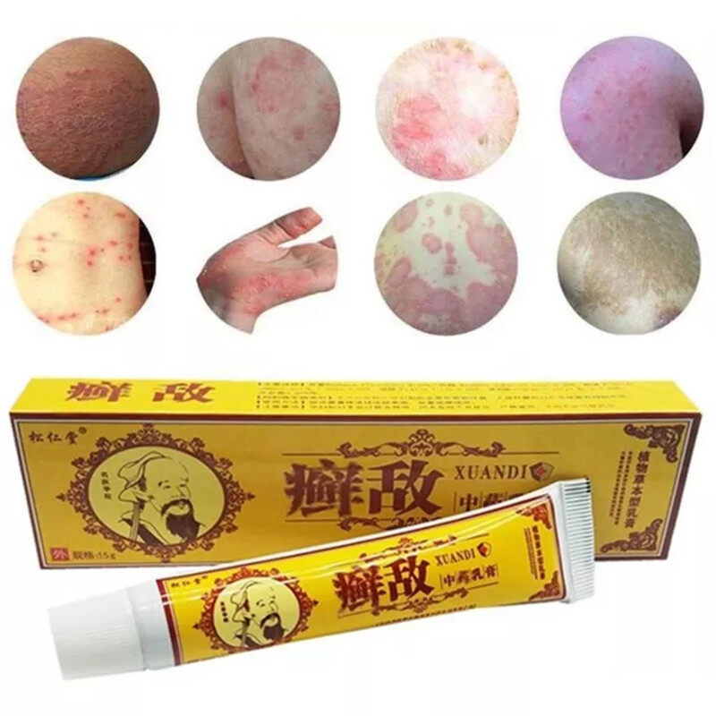 15g Psoriasis Skin Disease Treatment Cream Eczema Dermatitis Herbal