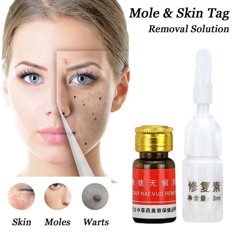 Mole Removal Cream Freckle Removal Cream Removal Solution Repair ...
