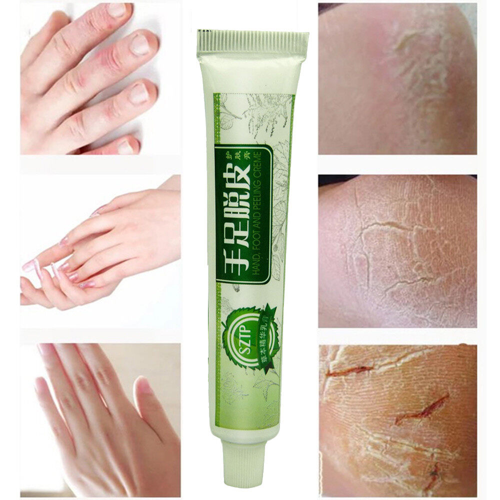 Cracked heel Balm Cream for ROUGH DRY & cracked chapped Feet heel Skin ...