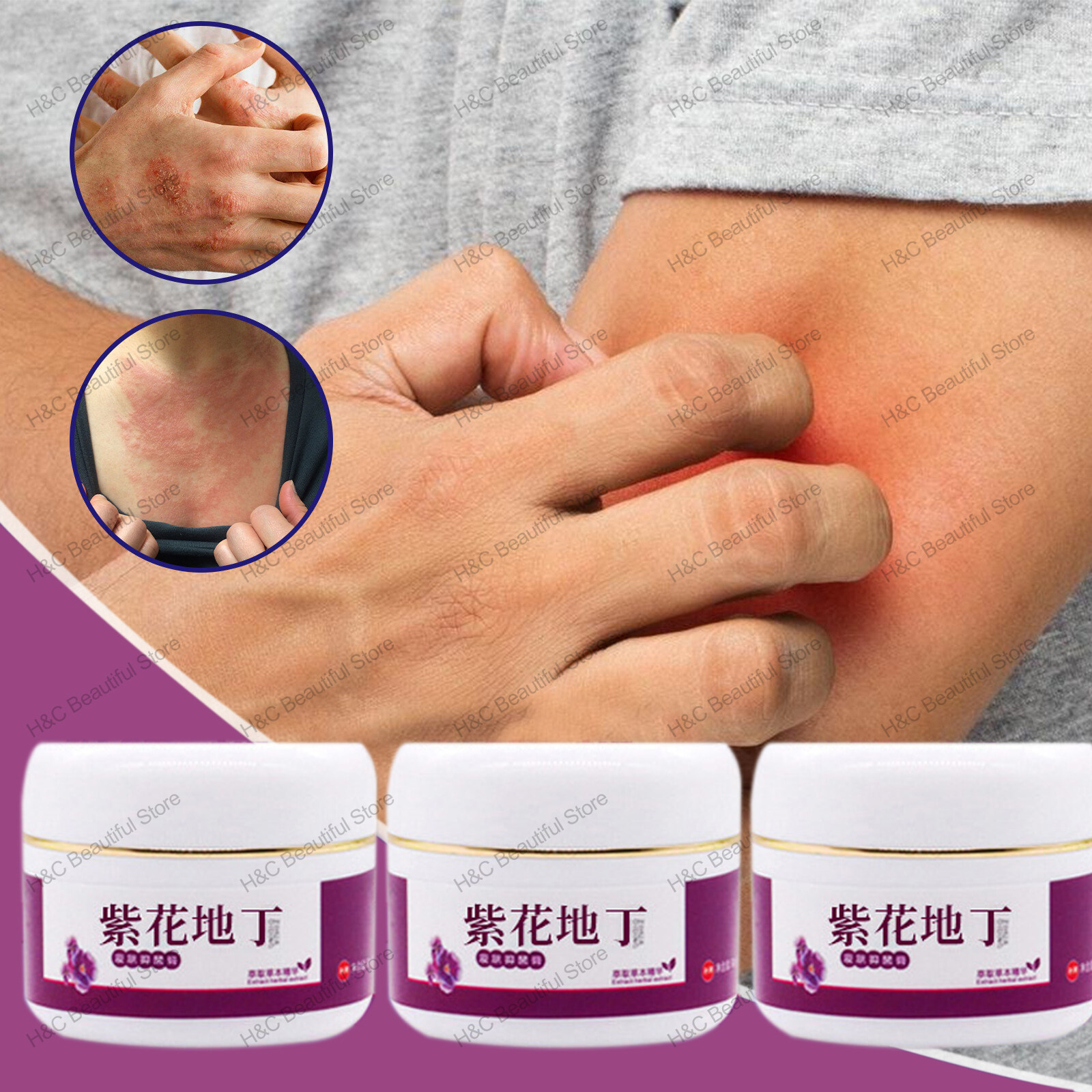Eczema Ointment Itching Cream Antibacterial and antipruritic cream 30g ...