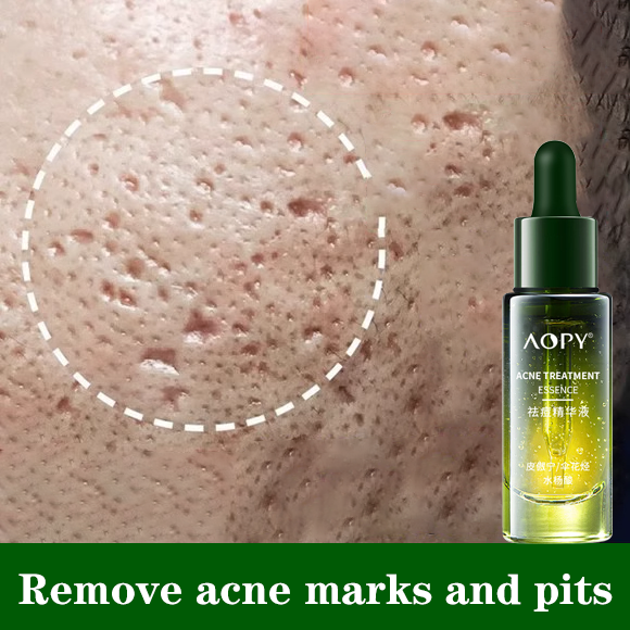 Acne pit and cavity repair magic device to lighten acne marks, male and ...